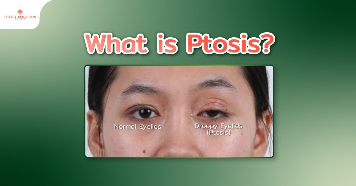What Causes of Ptosis and How It Impacts Your Vision and Look