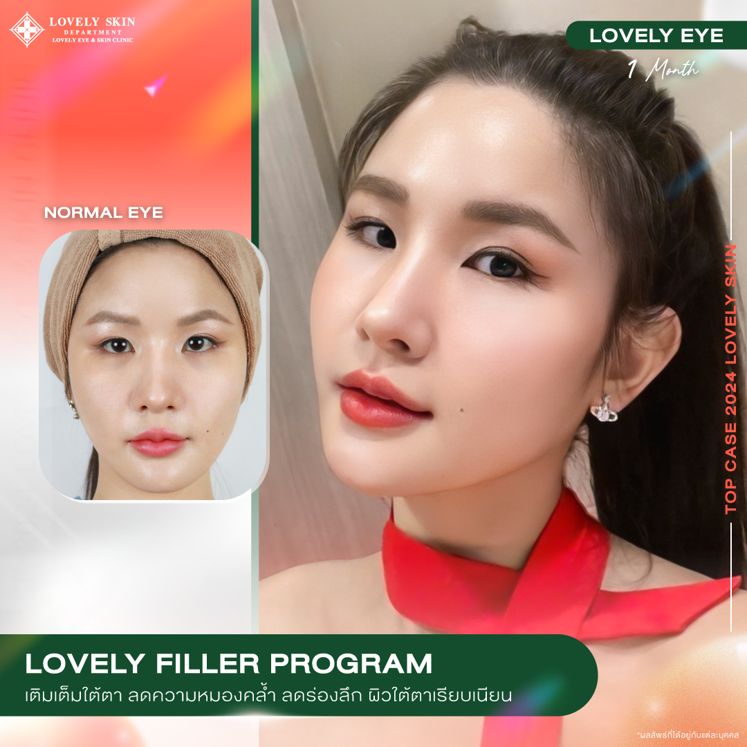 เติมฟิลเลอร์ใต้ตา แก้ใต้ตาคล้ำ ราคาเท่าไร? ดูเคสรีวิวจาก Lovely Eye ได้ ...